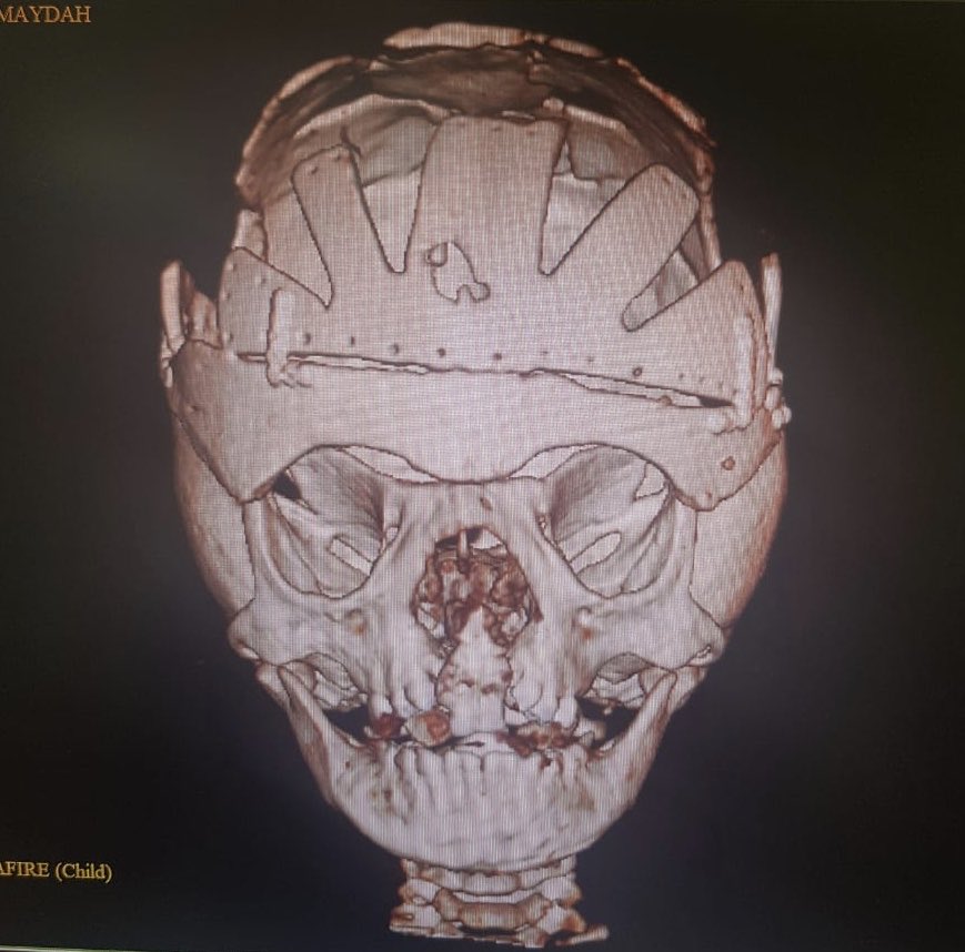 Khawla Hospital successfully performs complex head operation for child ...